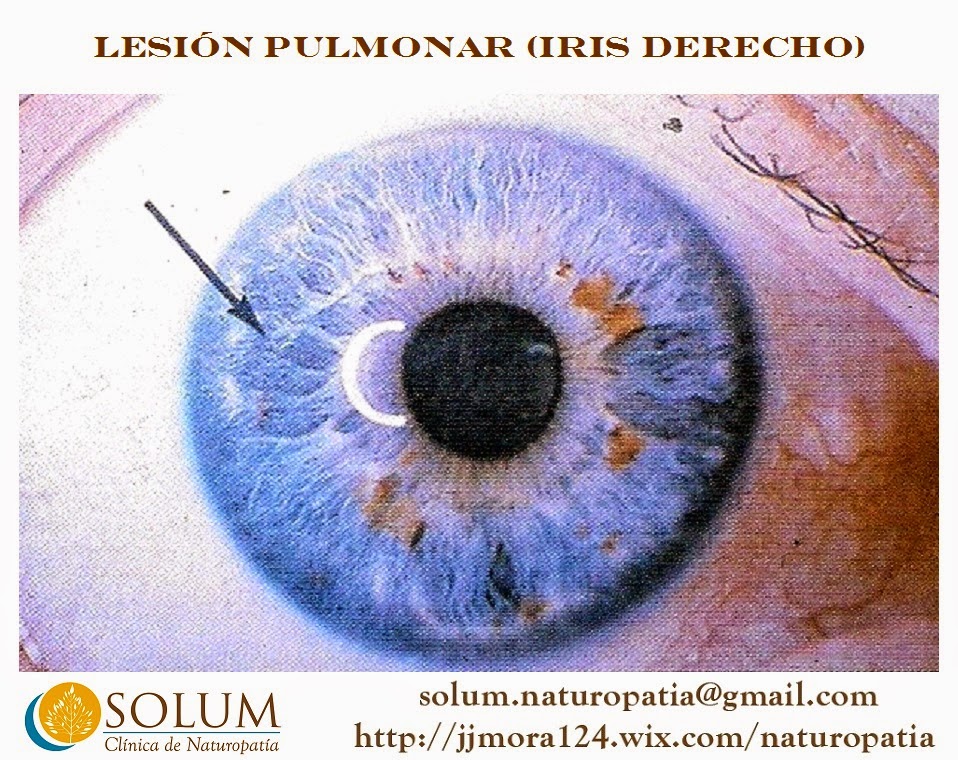 Enfermedades vistas a través del Iris.