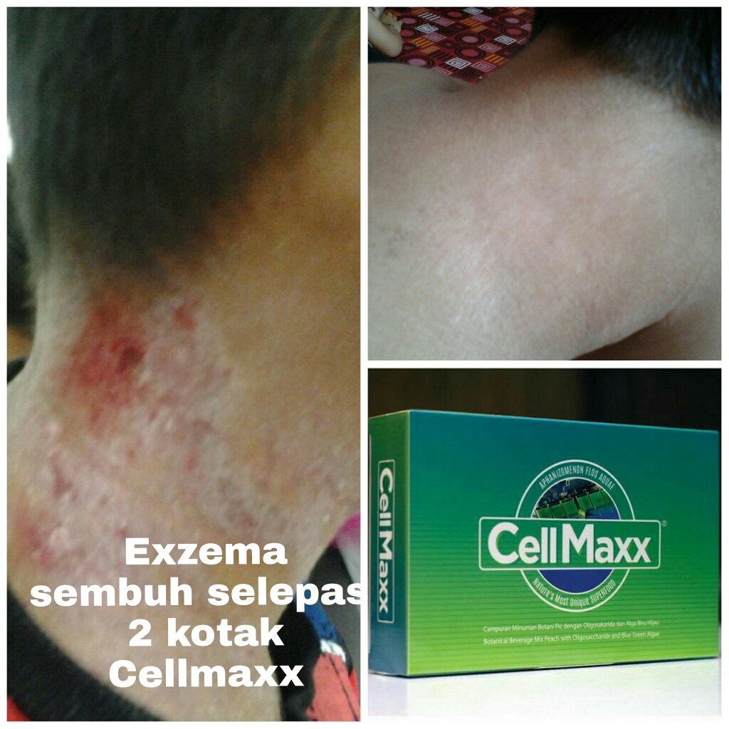 Maxxima Nutrition: Cellmaxx Testimoni Eczema