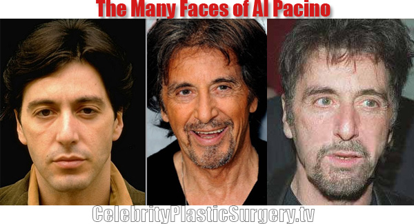 Al Pacino Plastic Surgery Before and After Nose Job, Botox, Browlift ...
