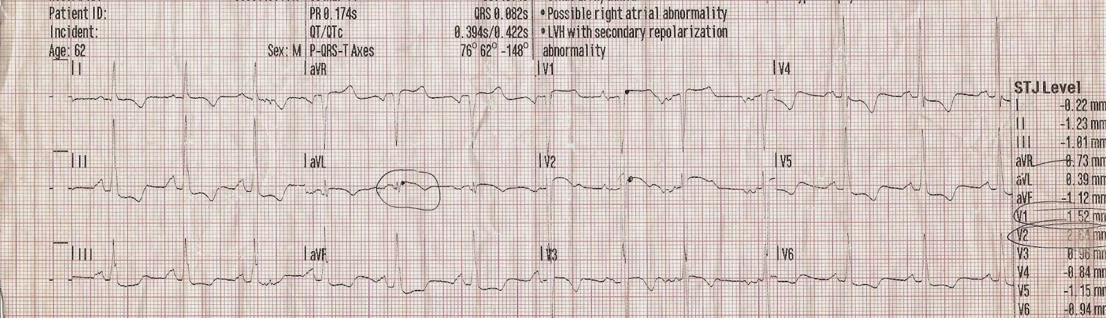 Infarction Ekg Septal Infarct
