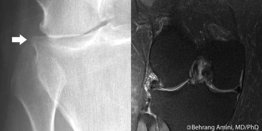 Roentgen Ray Reader: Rauber Sign