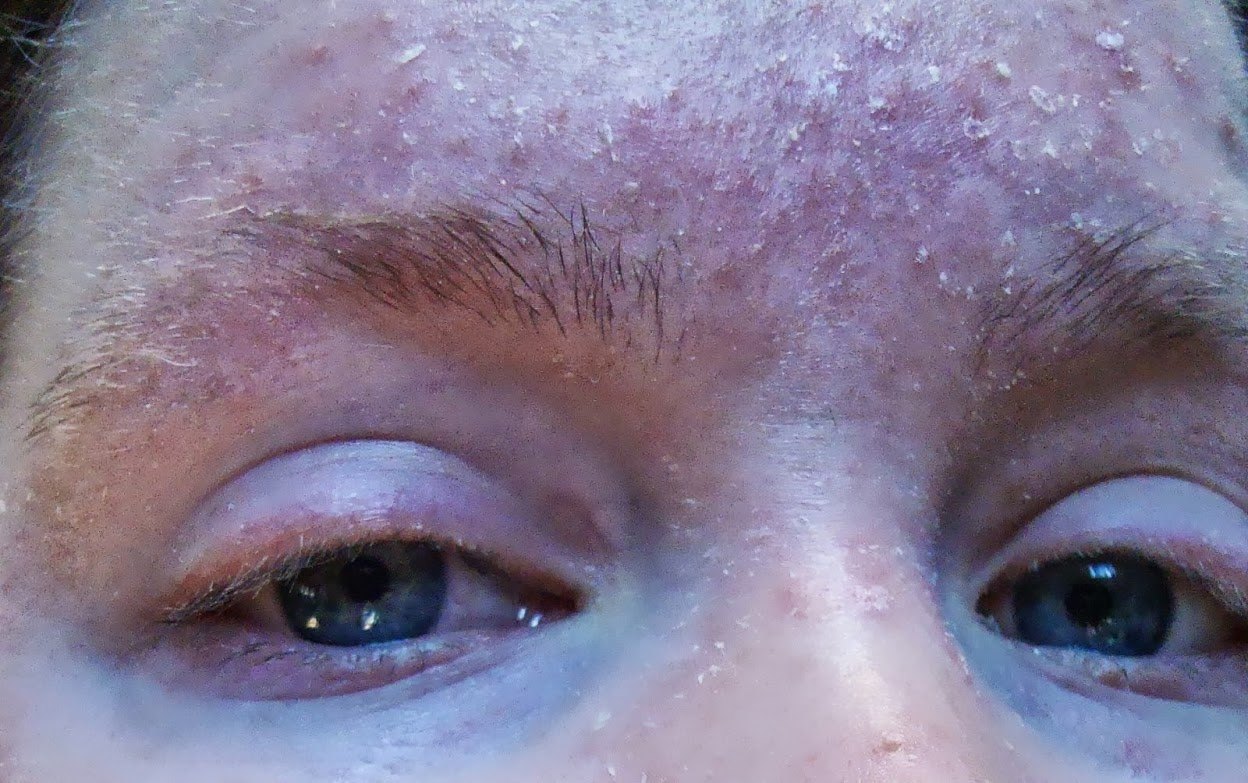 Scarlet Letters, dealing with vascular rosacea, face flushing, burning ...