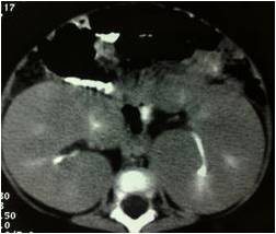 Radiologist For Ever: Renal rule 5 : Renal solid lesions