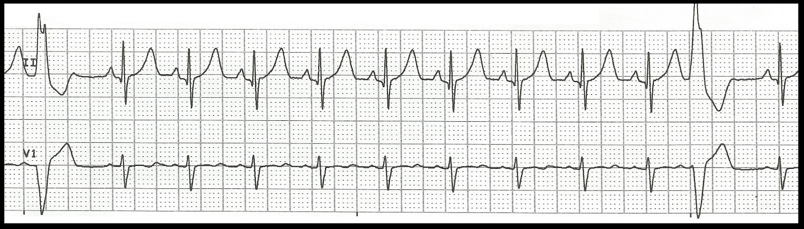 EKG Rhythm Strip Quiz 142