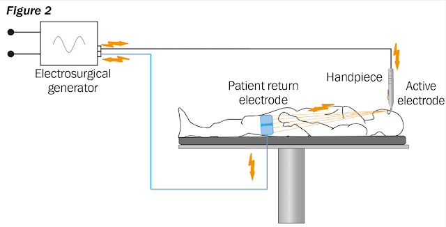 The Site for Healthcare Professionals: Electro Surgical Unit (ESU).
