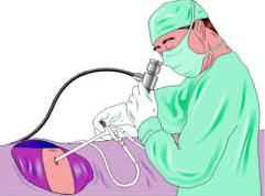 Thoracoscopy; Endoscopy, Pleural; Pleural Endoscopy; Pleuroscopy ...