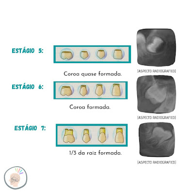 Canal da Odonto: CLASSIFICAÇÃO DE NOLLA