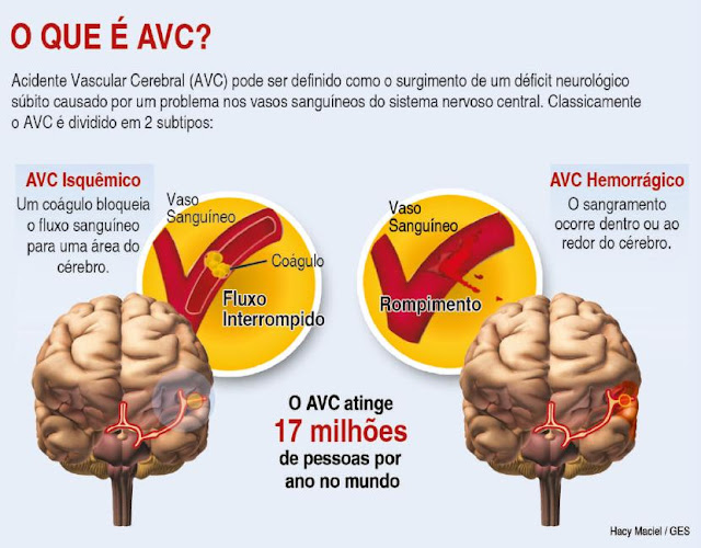 Arlan Alves : DIA MUNDIAL DE COMBATE AO ACIDENTE VASCULAR