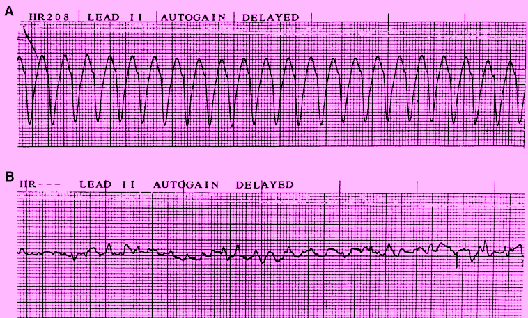 VENTRICULAR TACHYCARDIA | MANAGEMENT OF HEART DISEASE