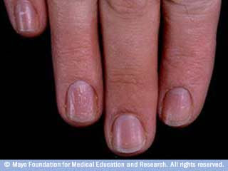 HealthyThyroidLady ™: WHAT COLOR IS YOUR LUNULA?