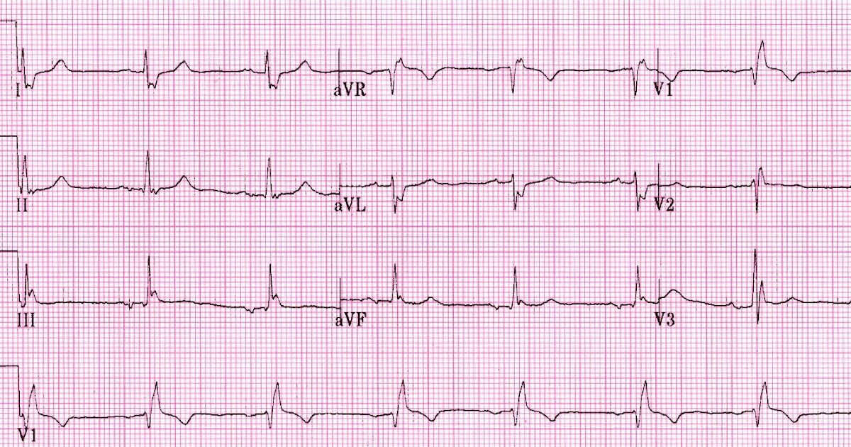 Study Medical Photos: Right Bundle Branch Block - ECG