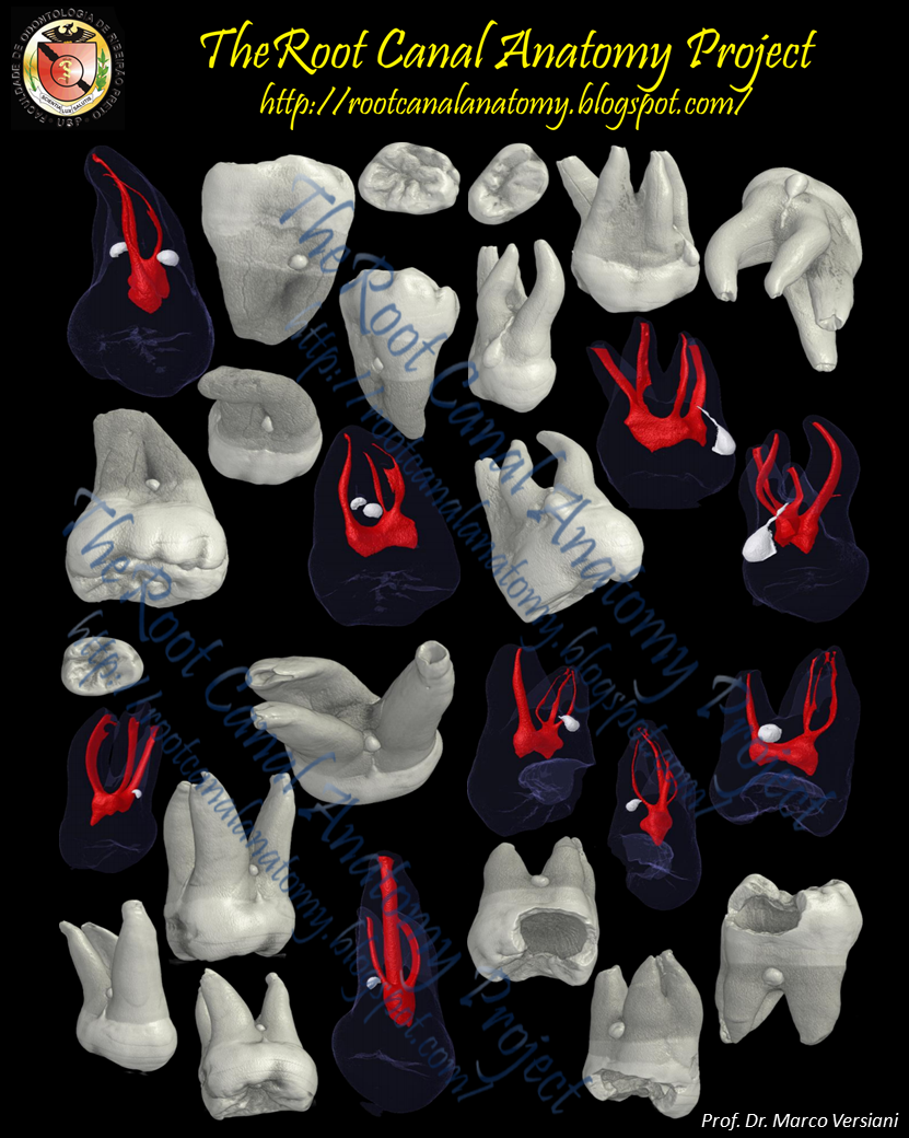 The Root Canal Anatomy Project: Enamel Pearls in Permanent Dentition