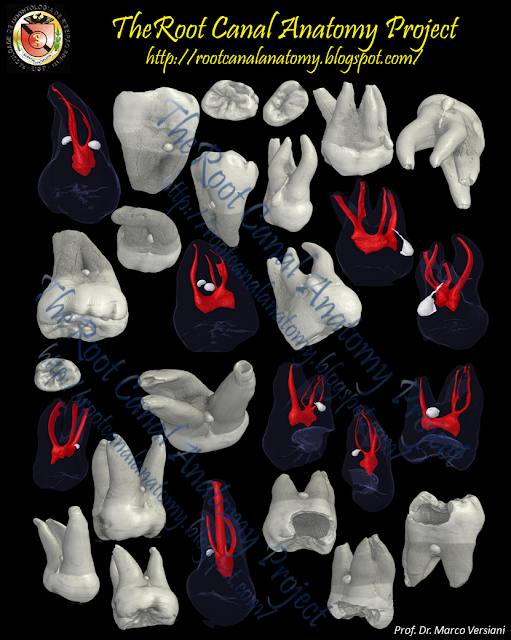 The Root Canal Anatomy Project: Enamel Pearls in Permanent Dentition