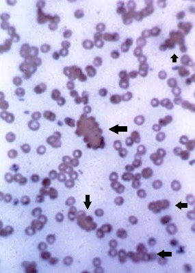 FICHERO DE HEMATOLOGÍA: ANORMALIDADES ERITROCITARIAS. Anormalidades de ...
