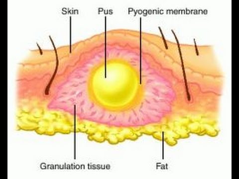 Halo Hendika : LP ABSES