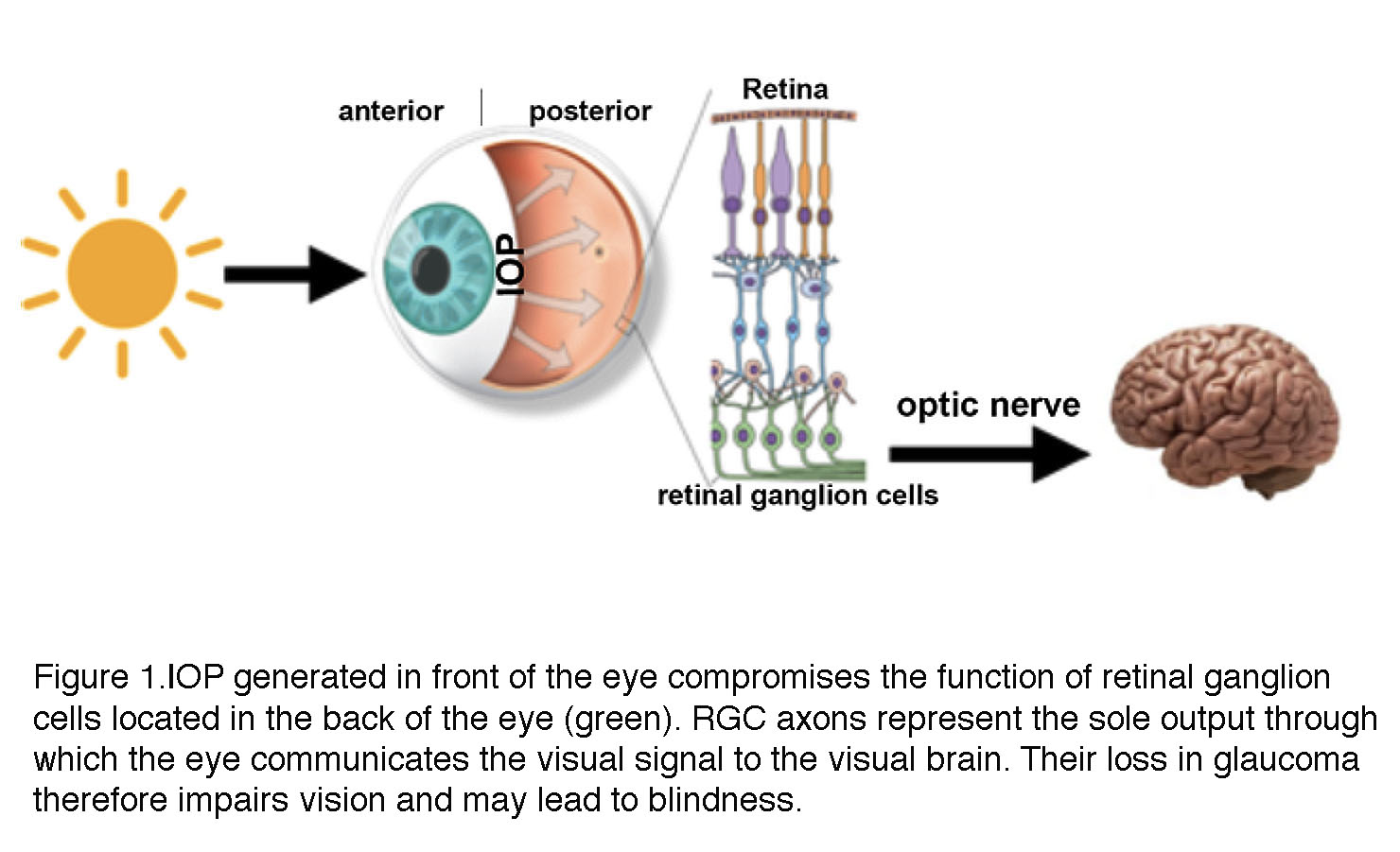 GLAUCOMA SPECIALIST BLOG: "THE GLOG": COLOR VISION CHANGES IN GLAUCOMA