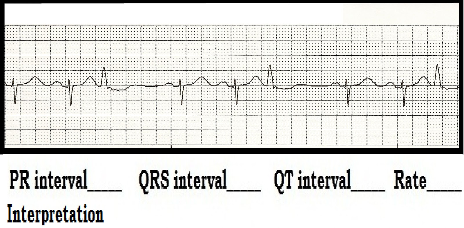 ECG Rhythm Strip Quiz 89 Interval Measurements ecg-rhythm-strip-quiz-89-interval-measurements