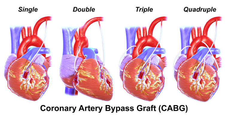 Coronary Artery Bypass Graft Definition, Risks, Cost
