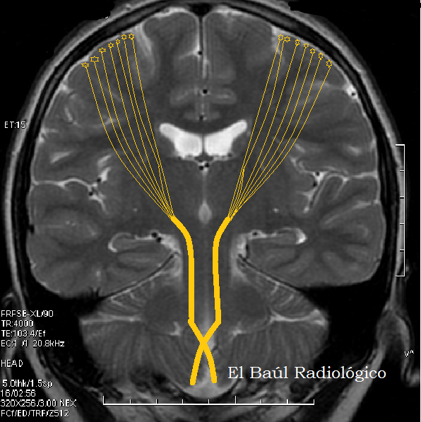 Angioresonancia cerebral con contraste - ntmoli