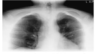 Chest apicogram AP x-ray in hindi - paramedical guru