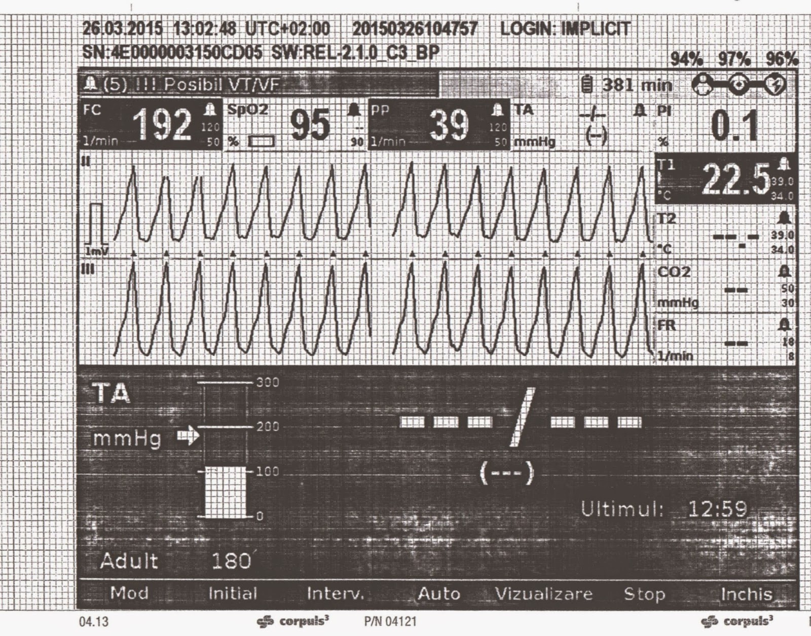 Tahicardie ventriculara cu puls