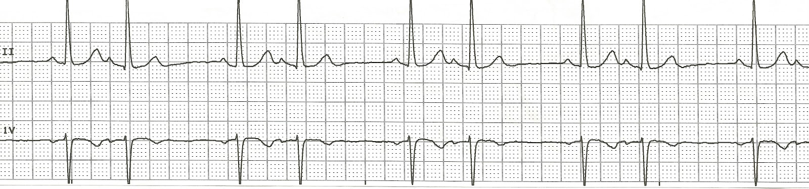 EKG Rhythm Strips 75