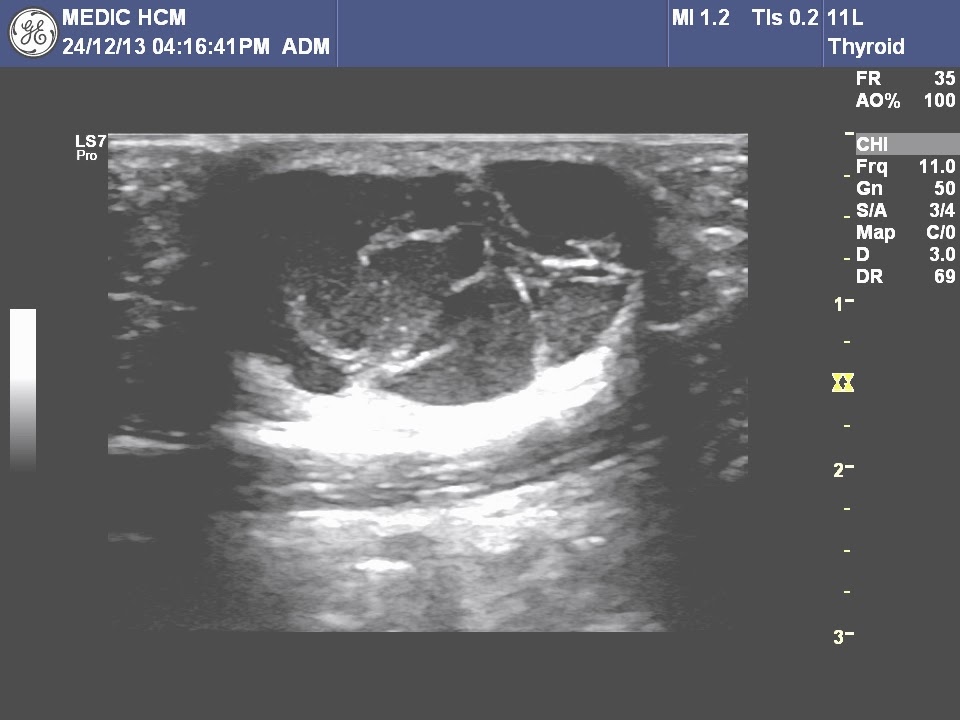 VIETNAMESE MEDIC ULTRASOUND: CASE 229: UMBILICAL TUMOR, Dr PHAN THANH ...