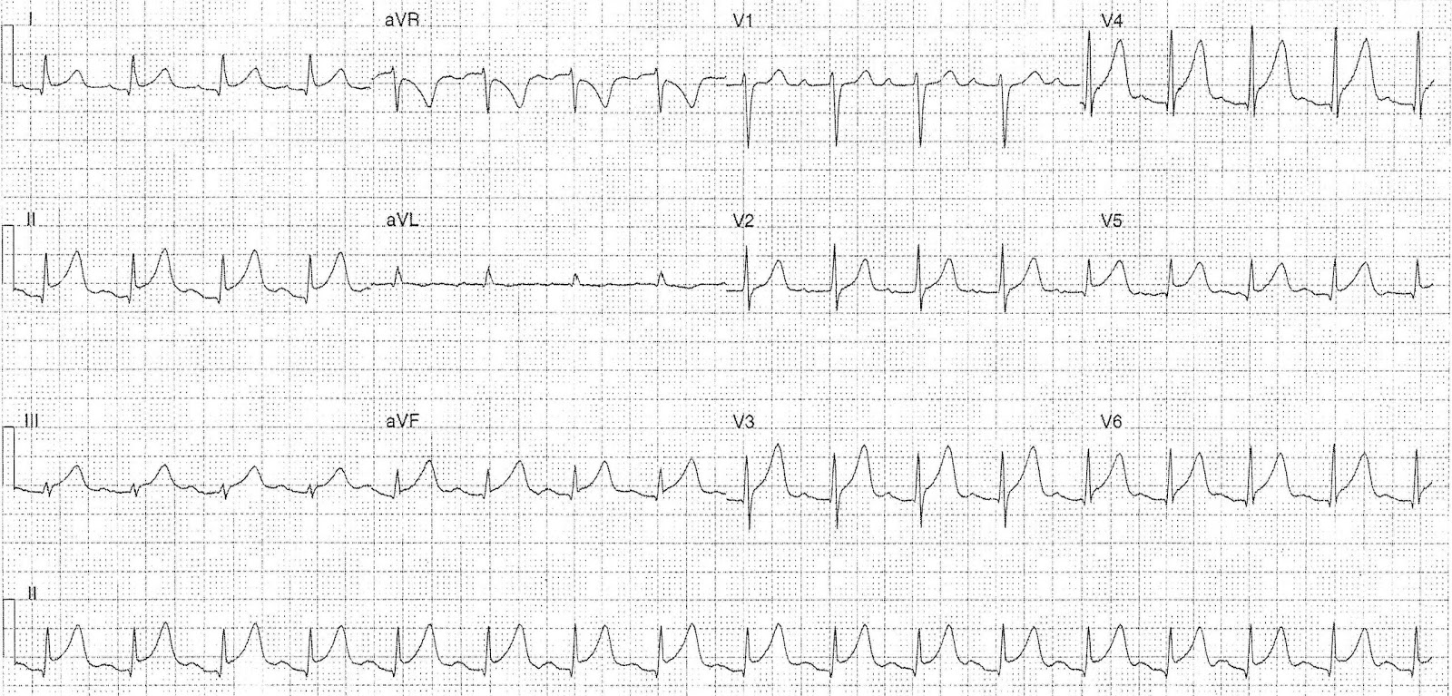 ECG of the Week: ECG of the Week - 20th August 2018