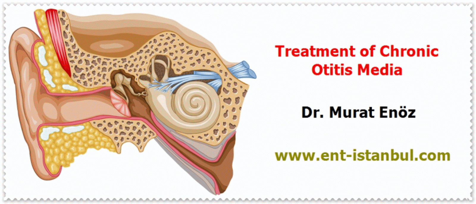 Chronic Otitis Media - Definition, Symptoms, Complications and Treatment