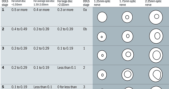 Ophthalmology Notes: Disc Damage Likelihood Scale (DDLS)