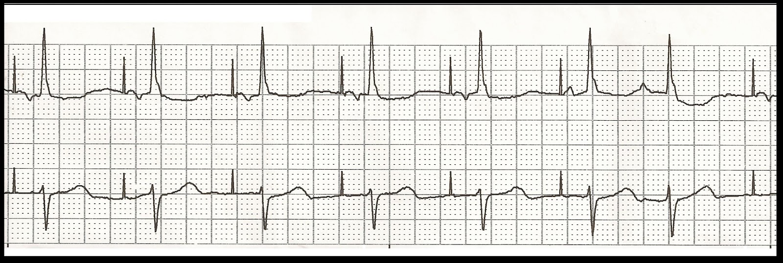 EKG Rhythm Strip Quiz 100: Paced rhythms
