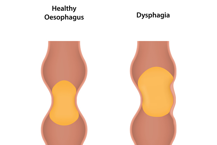 Kharghar Medicity Hospital: Causes and Symptoms of Dysphagia