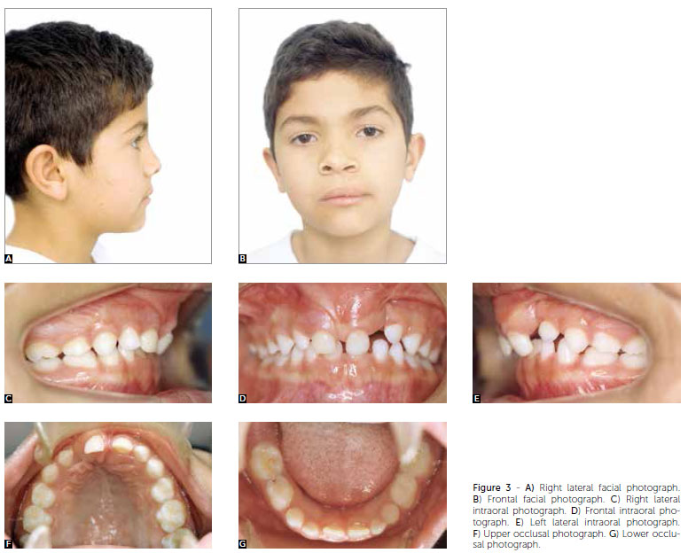 Pediatric Dentist, Bangalore: Cleft Lip - Handling This Congenital ...