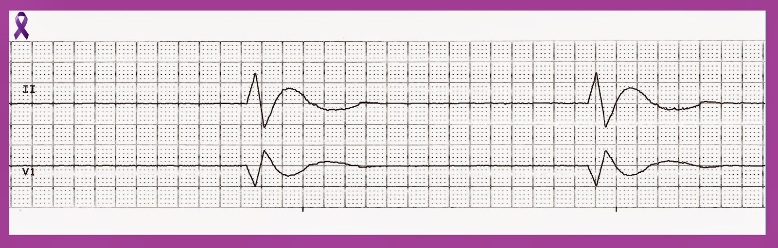 Practice EKG Strips 361