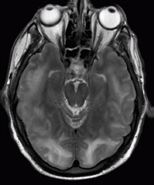 Borborygmus: Posterior Reversible Encephalopathy Syndrome