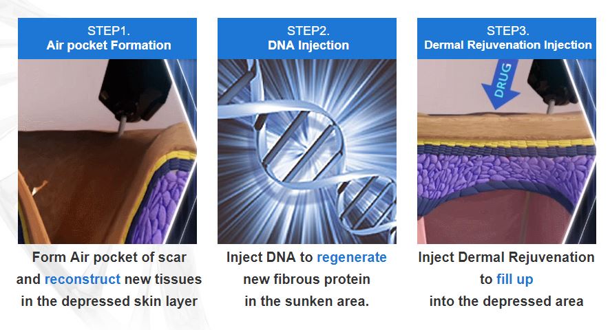 Renewme Skin Clinic: NEW 2019 Acne scar treatment; DNA Dermal Rejuvenation
