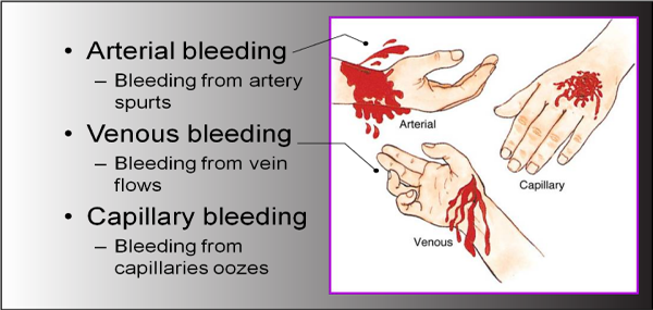 Haemorrhage or bleeding , type of haemorrhage or control of bleeding