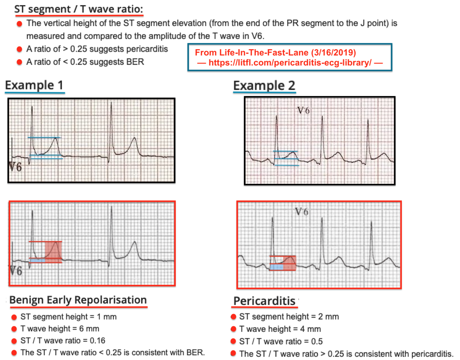 Dr. Smith's ECG Blog: "Pericarditis" strikes again