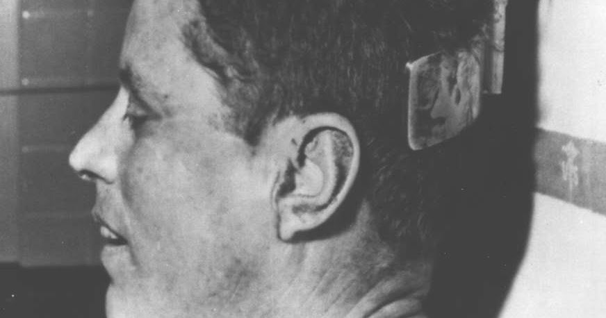 DVP's JFK ARCHIVES: THE LOCATION OF JFK'S BACK WOUND