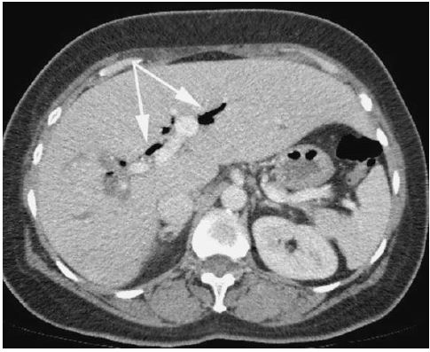 CT scan biliary gas