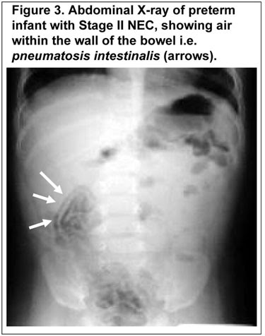 HEALTH FROM TRUSTED SOURCES: Necrotizing enterocolitis