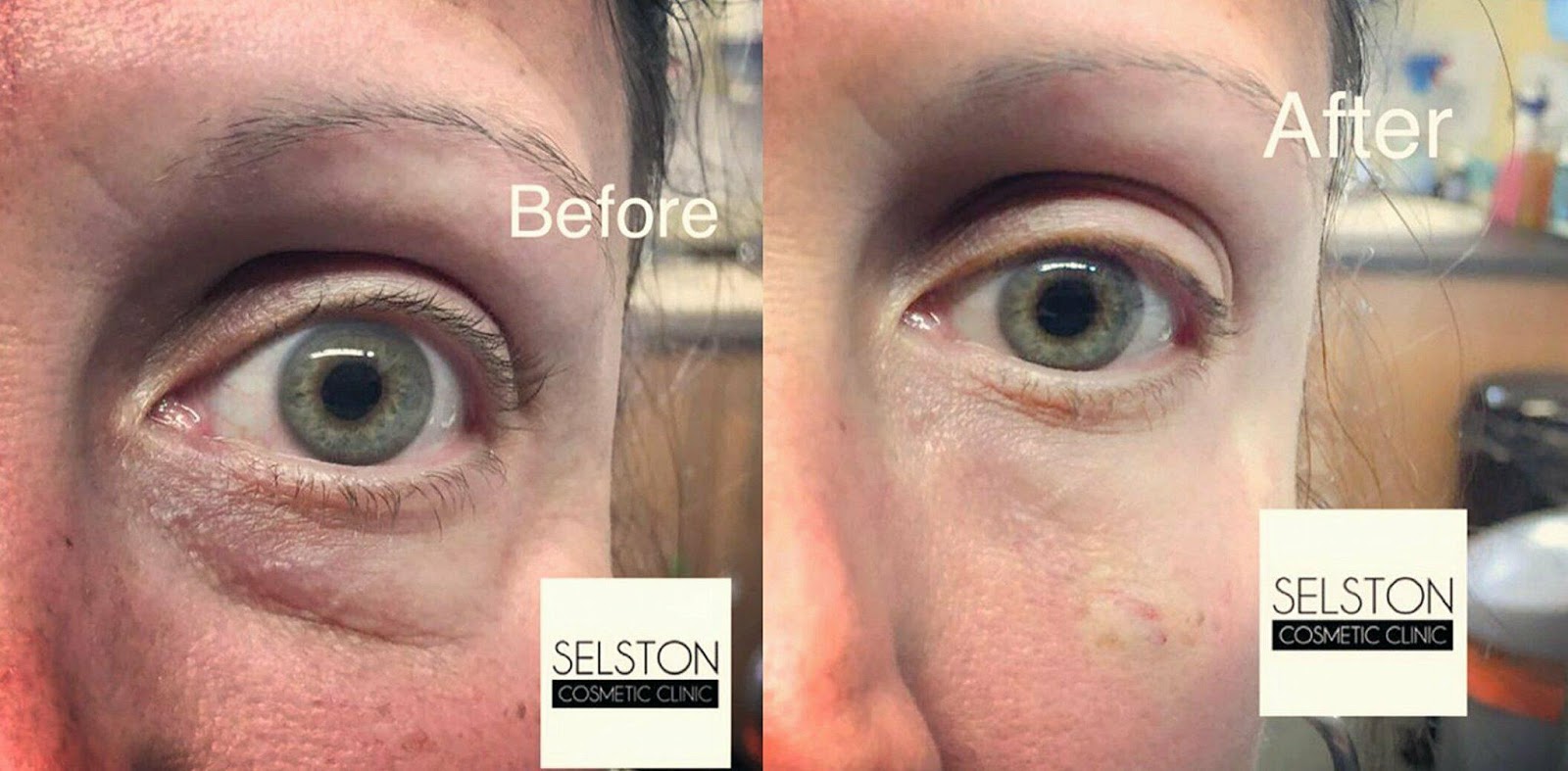 Selston Cosmetic Clinic: Fill in Hollow Tear Troughs With Dermal Filler ...