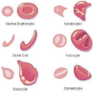 Morfologi Abnormal Eritrosit | Uchaal