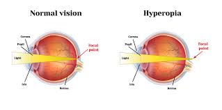 What is Glaucoma? Causes, symptoms, How Can It Be Prevented?