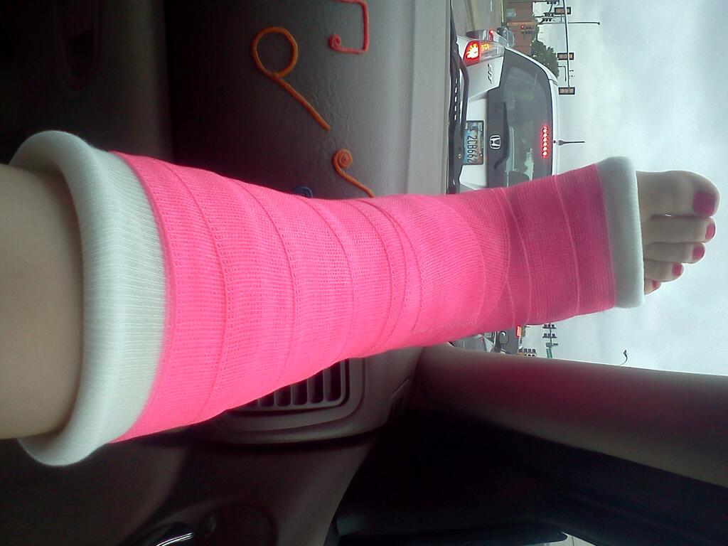 Casts and Toes: Some Short Leg Cast Pics