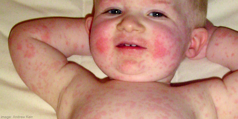 هل تعرف ما هو المرض الخامس واعراضه ؟؟ (Fifth disease) ~ كل يوم دواء ...