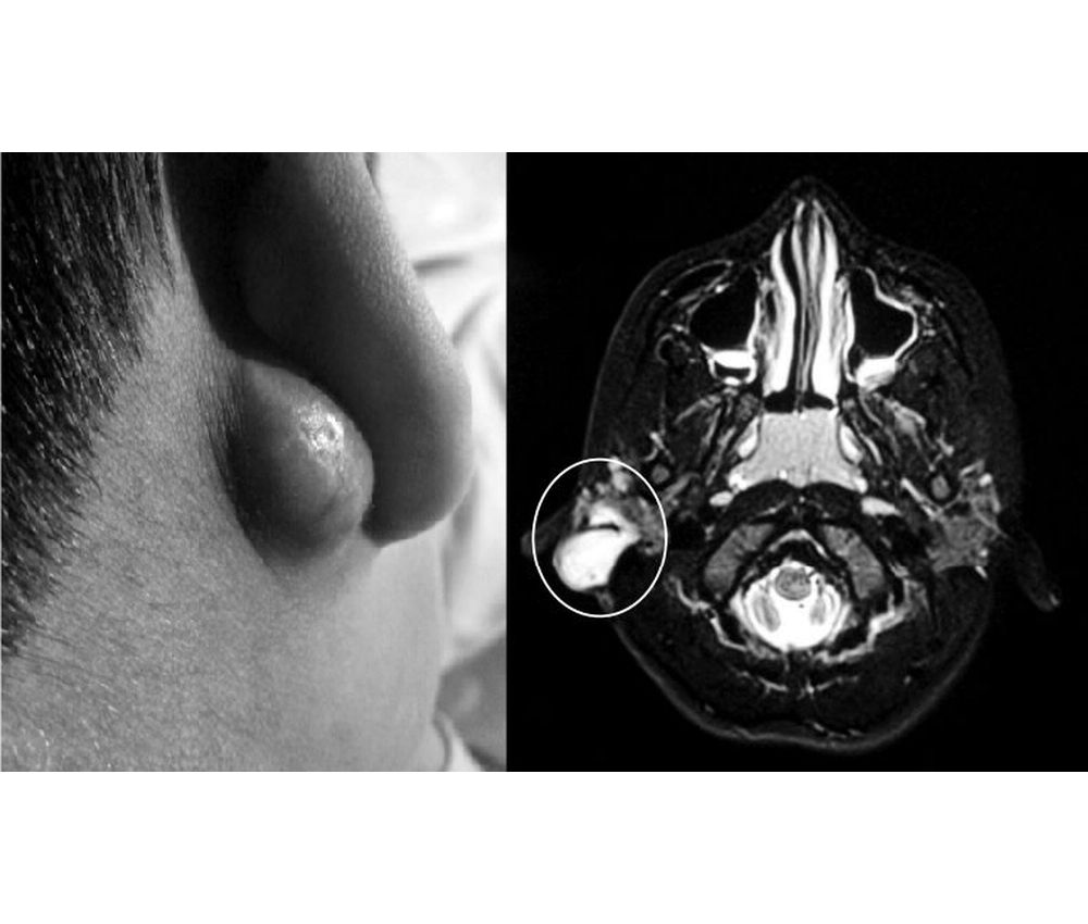 Embriología: Malformaciones y anomalías de los arcos branquiales ...
