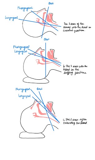 Medicowesome: Endotracheal intubation