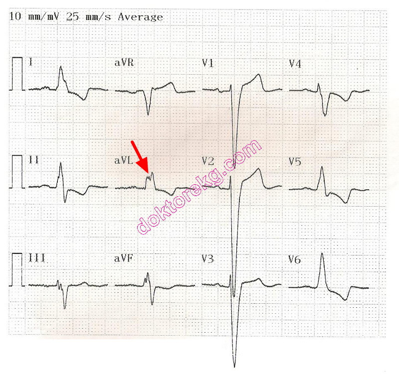 Chapman's Sign | INA - ECG