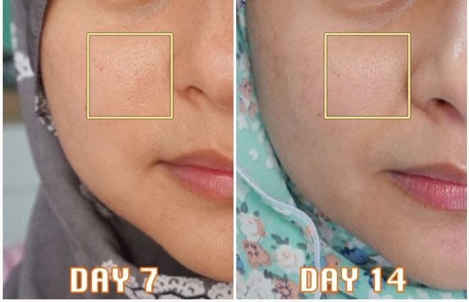 Bagaimana Cara Nak Atasi Kulit Breakout Teruk Akibat Salah Guna Produk? ~ Sina Shaari